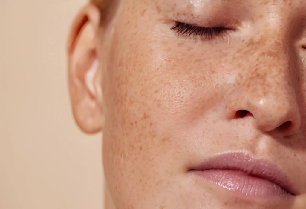 How Do You Remove Freckles? Safe Options for Clearer Skin